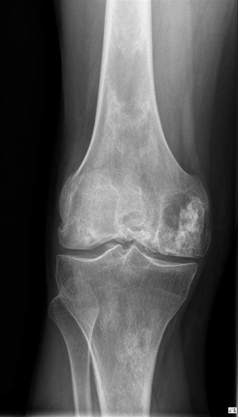 Avascular Necrosis Buyxraysonline