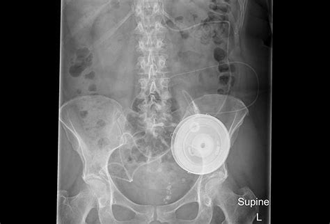 Intrathecal Pump On Xr Rebel Em Emergency Medicine Blog