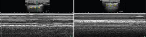 Point Of Care Lung Ultrasound Can Detect Endobronchial Intub Saudi