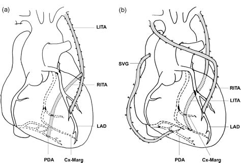 Internal Thoracic Artery