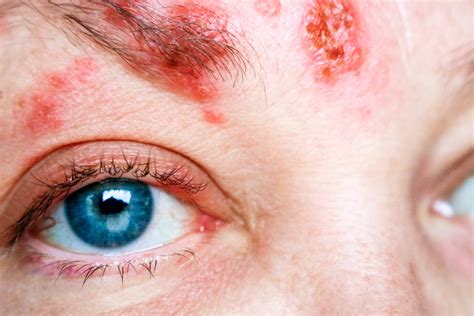 Herpes Zóster Como Diagnosticar e Tratar GeriClass