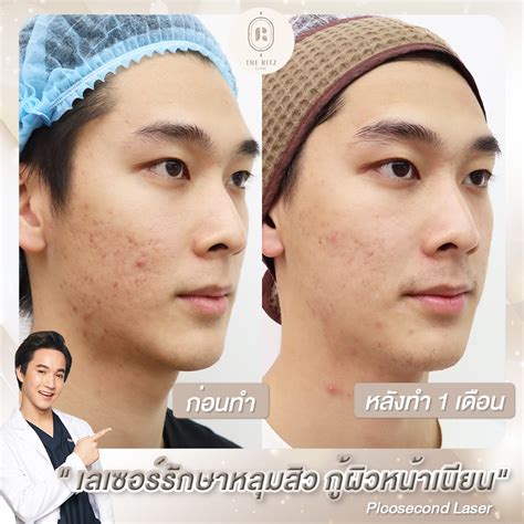 The Ritz รีวิวรักษาหลุมสิวด้วย Pico Scar หรือเครื่อง Facebook