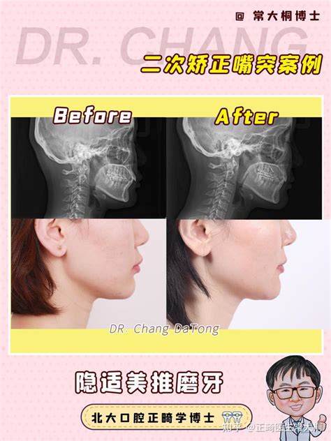 美观大作战⚠️二次矫正有没有必要进行？ 知乎