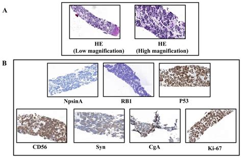 He And Ihc Staining After Liver Metastasis A He Staining Showed That Download Scientific