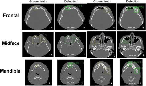 Maxillofacial Fracture Detection And Classification In Computed Tomography Images Using