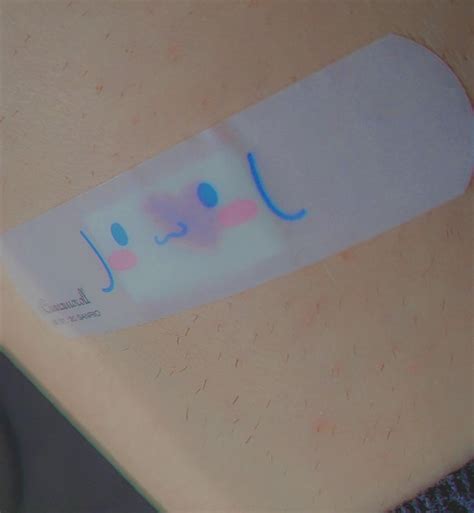 I Hit A Capillary While Doing My Injection But Look The Blood