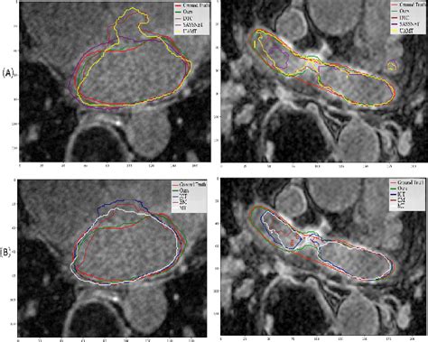 Figure From Semi Supervised Unpaired Medical Image Segmentation Through Task Affinity