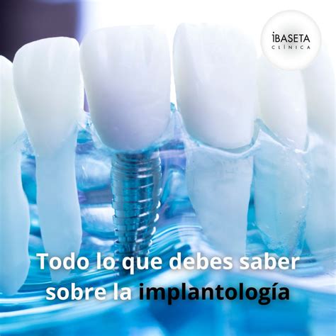 Todo lo que debes saber sobre la implantología Clínica Ibaseta