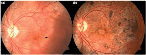 Fundus Photograph Of Left Eye Of Patient 8 At Presentation A Showing