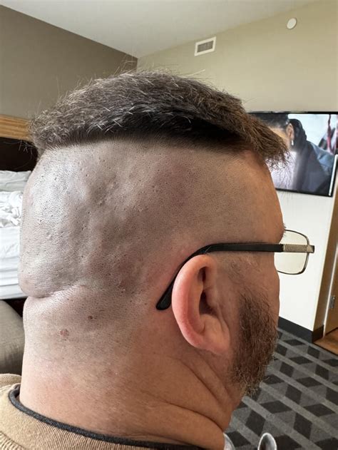 Sores And Issues On Scalp Rmedical