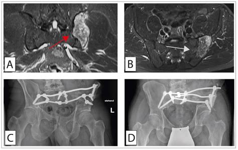 Chondrosarcoma Of The Pelvis Treated With Wide Resection And Download Scientific Diagram