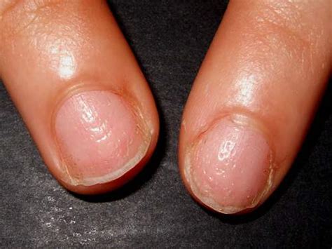 14 Nail Pitting Or Rippled Nails