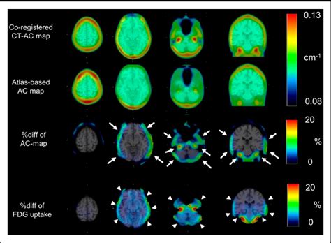 Figure 1 From Evaluation Of Atlas Based Attenuation Correction For
