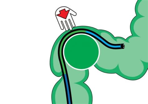 Hepatic Flexure Intubation Colon Explorer