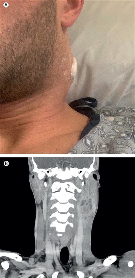 Lymphogranuloma Venereum