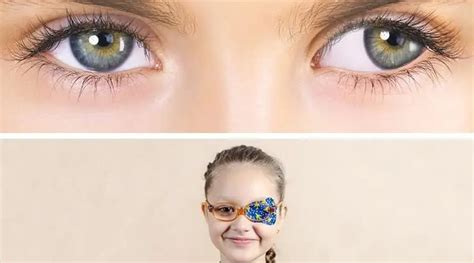 Eye Amblyopia Causes Symptoms Diagnosis Treatment Prevention