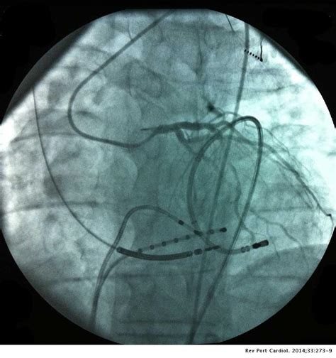 Percutaneous Epicardial Ablation In Ventricular Arrhythmias Revista