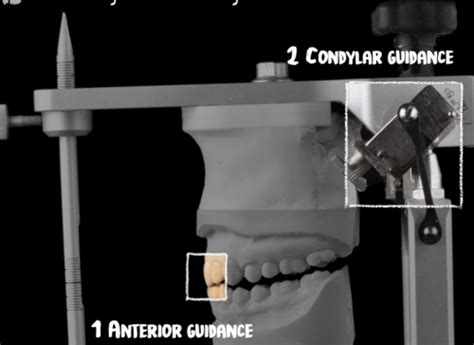 Occlusion Flashcards Quizlet