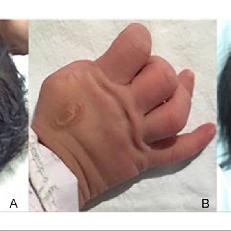 Aplasia Cutis Presents With An Area Of Scalp Defect At Birth A Download Scientific Diagram