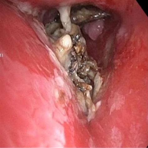 Image Captured During Bronchoscopy Visualizing What Appeared As