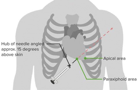 Ppt Pericardial Effusion And Cardiac Tamponade Powerpoint My Xxx Hot Girl