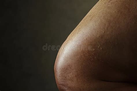 Close Up Of Fat Swollen Leg Showing Inflammation And Edema Stock