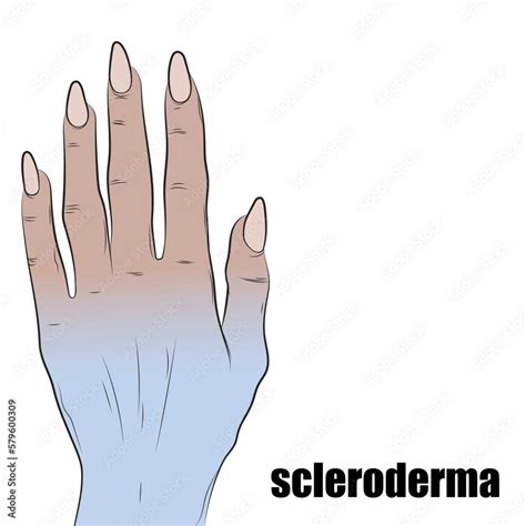 Vetor De Scleroderma A Chronic Disease Of Women Makes The Skin Thick Causes Inflammation In