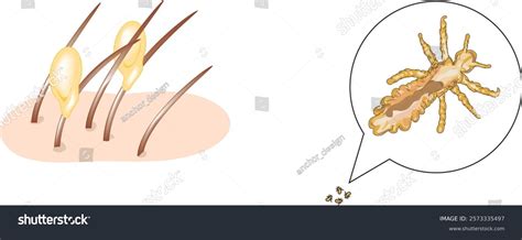 Diagram Explaining Structure Location Lice Nits Stock Vector Royalty