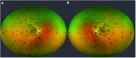 Topographical Distribution Of Choroidal Nevi In The Korean Population