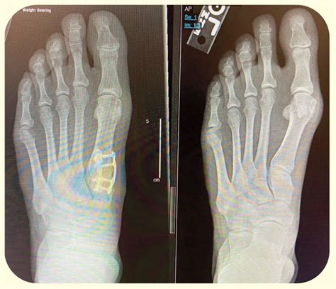 Modified Lapidus Precise Bioscience