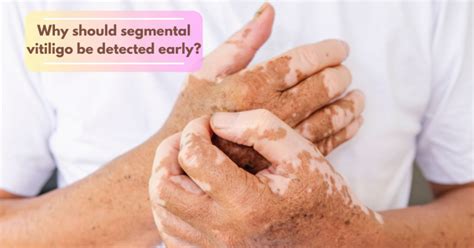 Why Should Segmental Vitiligo Be Detected Early Sri Ramakrishna Hospital