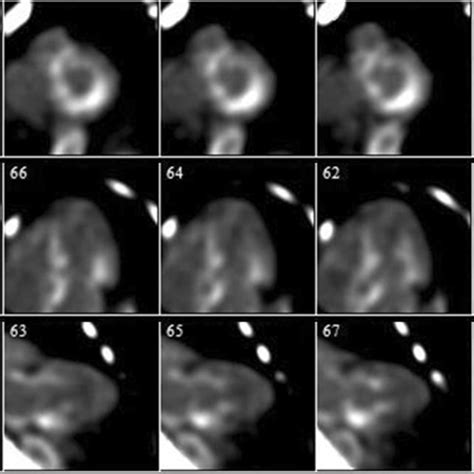 Diagnostic Algorithm Based On Bone Scintigraphy With 99mtc Pypdpdhmdp