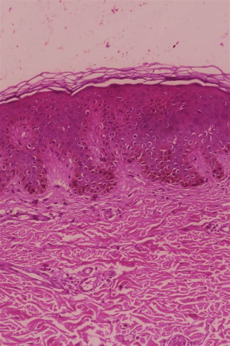 Hyperpigmented Macules With Hypertrichosis On Upper Chest Right