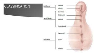 Hypospadias And Epispadiaspptx