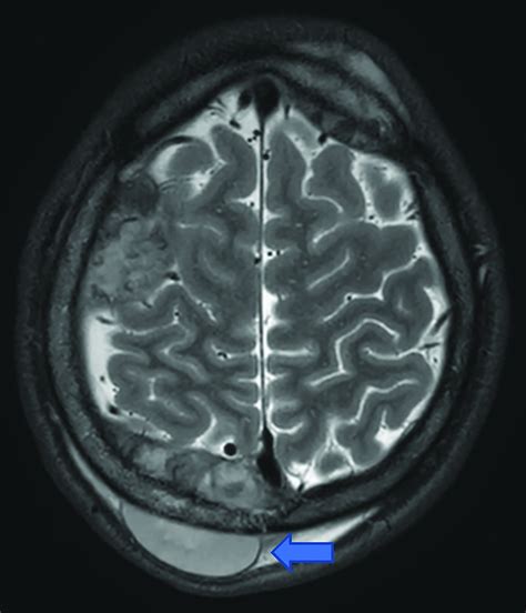 Ewing Sarcoma Applied Radiology Ewing Sarcoma Applied Radiology