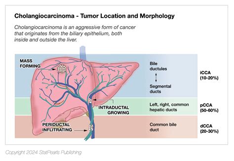 Cholangiocarcinoma Treatment And Management Point Of Care