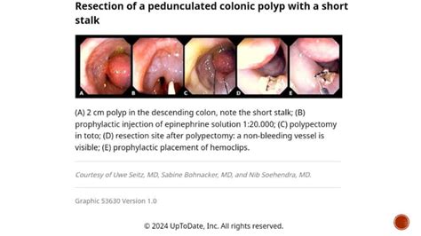 Polyps Colonic Endoscopic Finding Power Pointpptx