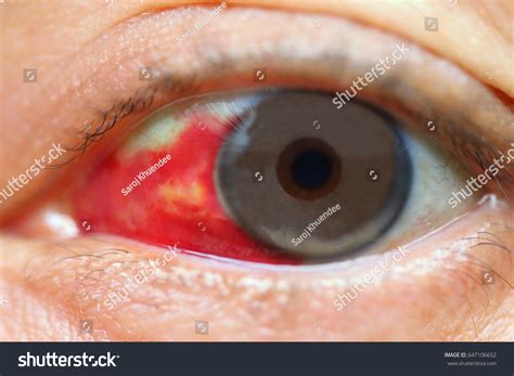 Eye Conjunctiva Sclera