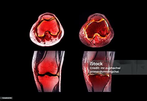 전방 십자 인대 의 눈물 이나 염좌를 감지하기 위한 자기 공명 화상 진찰 또는 Mri 무릎 관절 비교 관상 및 좌측 보기 무릎에