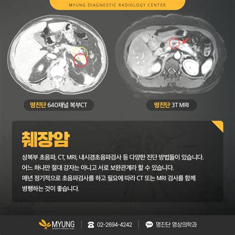 명진단 헬스케어 일찍 발견하기 어려운 췌장암 검사 방법에 대해 명진단 배민영 대표원장이 직접