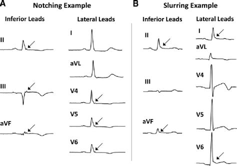 Figure 1 From Early Repolarization Associated With Ventricular Arrhythmias In Patients With