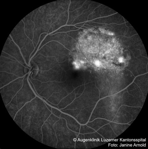 Central Serous Chorioretinopathy CSCR Ophtha Info