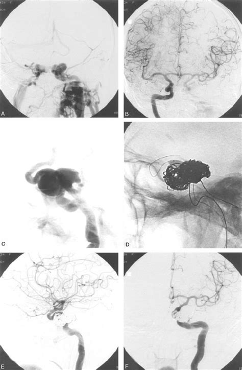 Patient 6 Ruptured Left Cavernous Sinus Aneurysm In A 70 Year Old