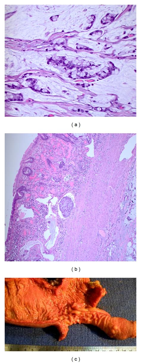 Histopathology Of Colon Biopsy At High Power Field Reveals Malignant