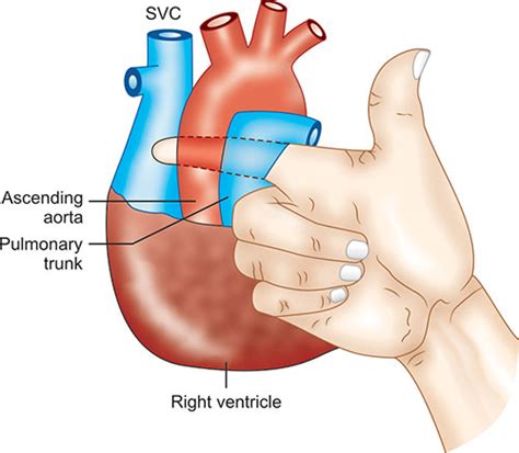 Transverse Pericardial Sinus
