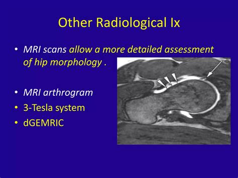 Femoroacetabular Impingement Syndrome Ppt
