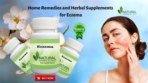 Natural Remedies For Eczema