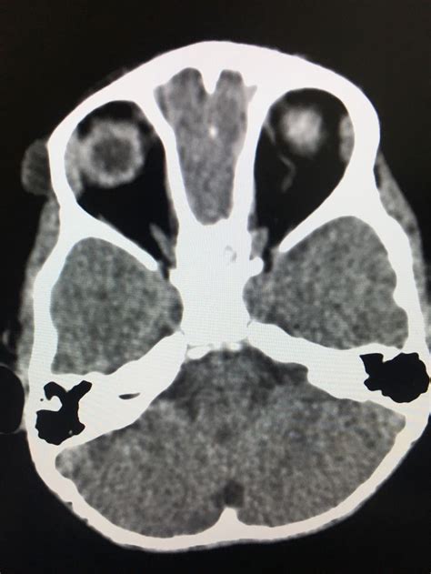 External Angular Dermoid
