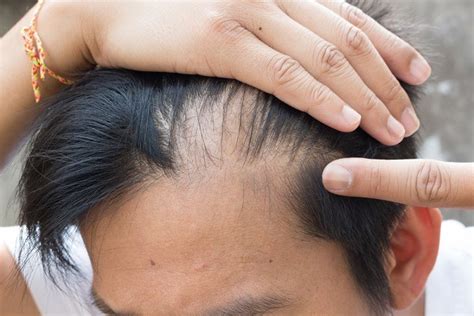 علاج تساقط الشعر للرجال حل مشكله وقوع الشعر عند الرجال دلع ورد