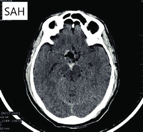 Postoperative Computed Tomography Showing Subarachnoid Hemorrhage In